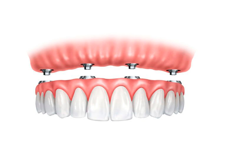 Implantes dentales Admodum - Etéreo Dentist